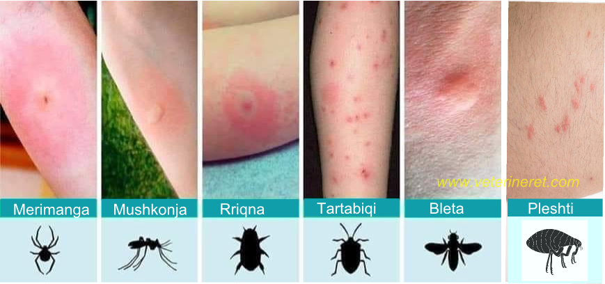 Stina e insekteve/ Mjekja: Çfarë duhet të dini për pickimet gjatë verës ...